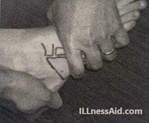 Cuboid Syndrome: Symptoms, Causes, Tests, & Treatment - ILLnessAid