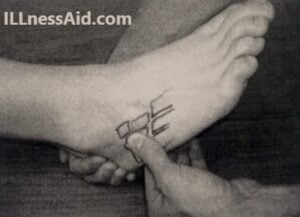 Cuboid Syndrome: Symptoms, Causes, Tests, & Treatment - ILLnessAid