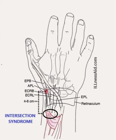 Intersection Syndrome Of The Wrist: Know All Details - ILLnessAid