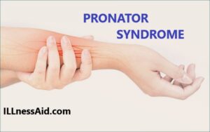 Pronator Syndrome: Cause, Examination, and Treatment - ILLnessAid