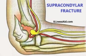 Supracondylar Fracture: Clinical features, Treatment, & More - ILLnessAid