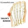 Tailor's Bunion: Causes, Exercises, And More - ILLnessAid