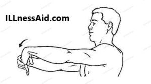 What is Carpal Boss Syndrome/ Os Styloideum? - ILLnessAid
